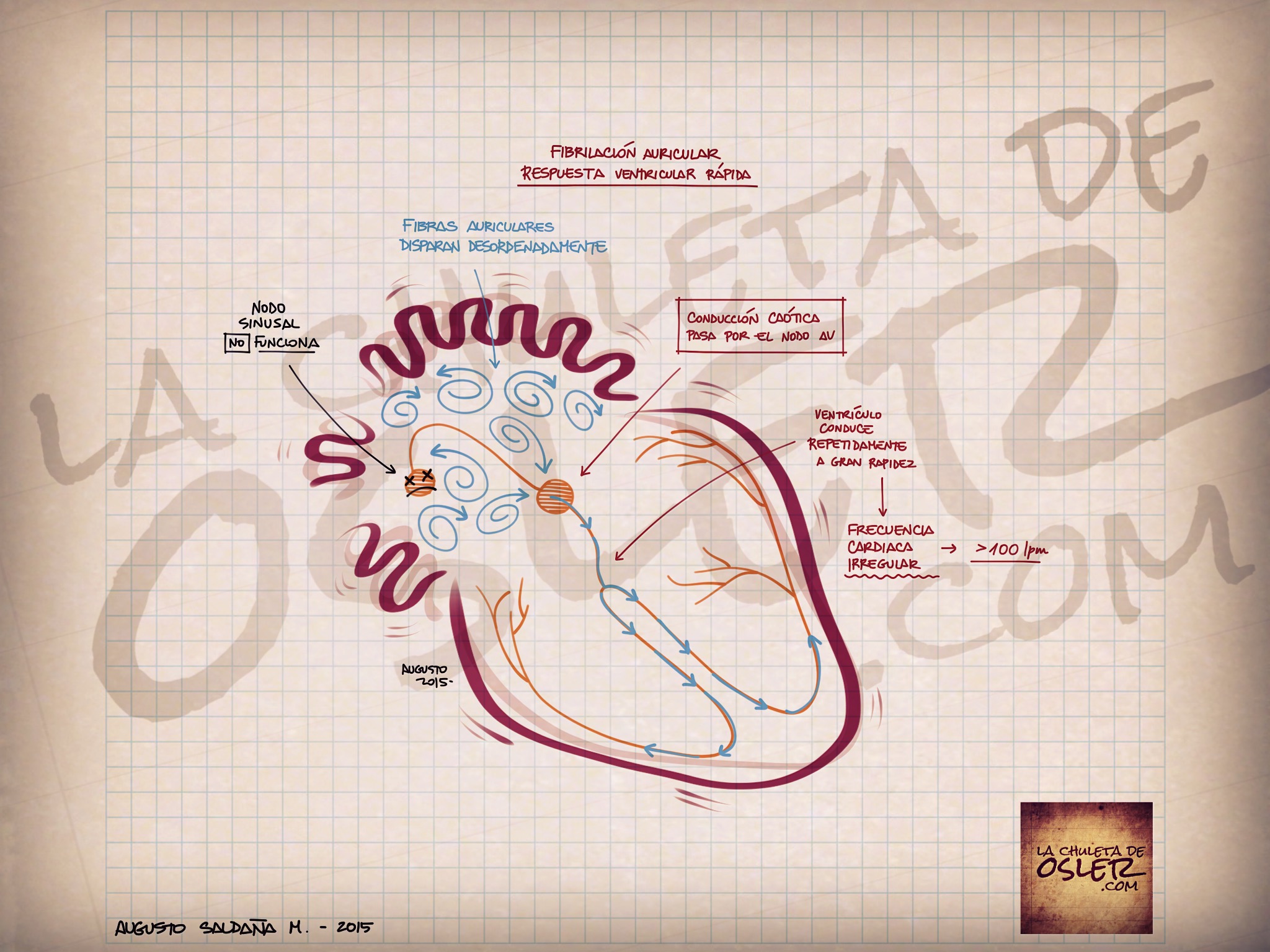 Fibrilación auricular, parte IV – La Chuleta de Osler