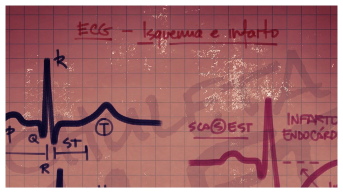 Cardiología – ECG: Isquemia e infarto