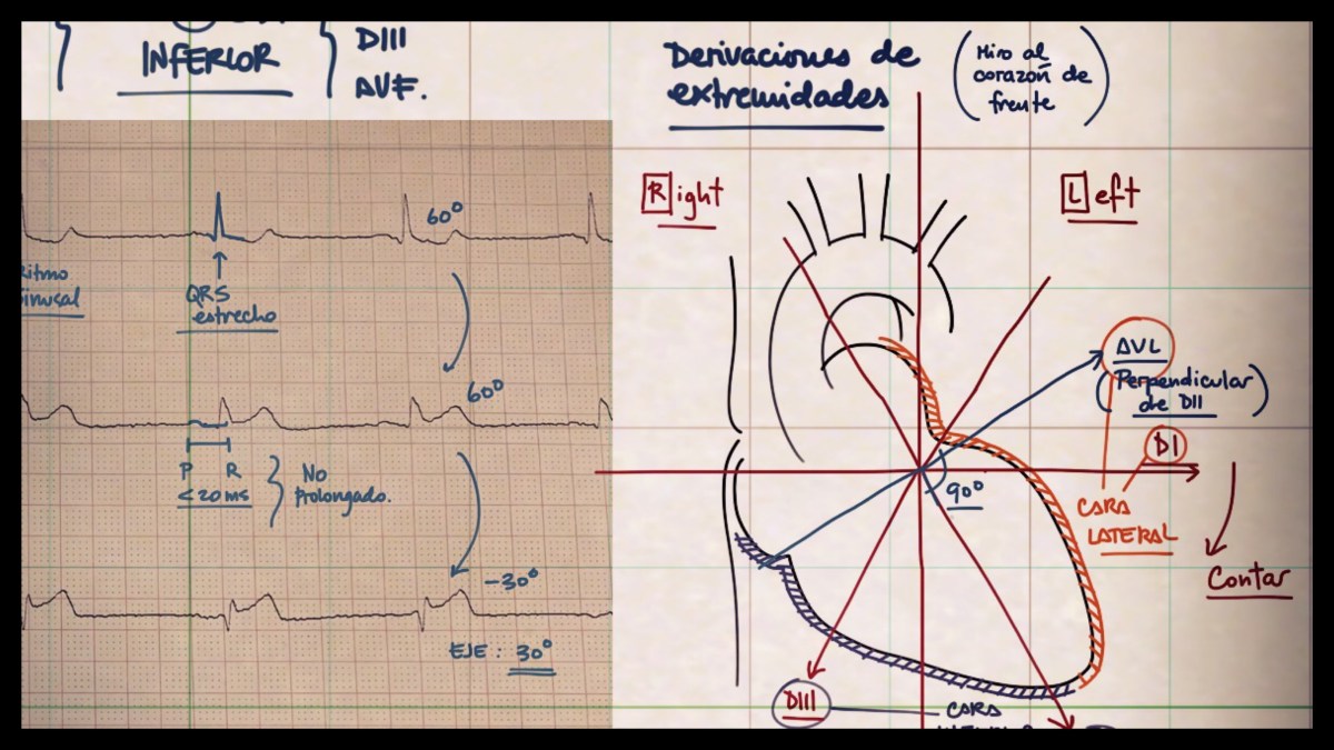 Cardiología – ECG: SCA con elevación ST inferior